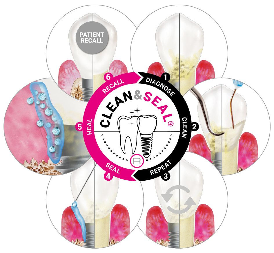 CLEAN & SEAL: de effectieve behandeling tegen parodontitis